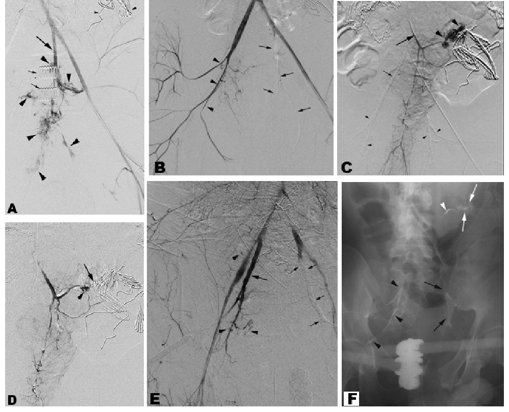 Full Text Usefulness Of N Butyl Cyanoacrylate Embolization Versus